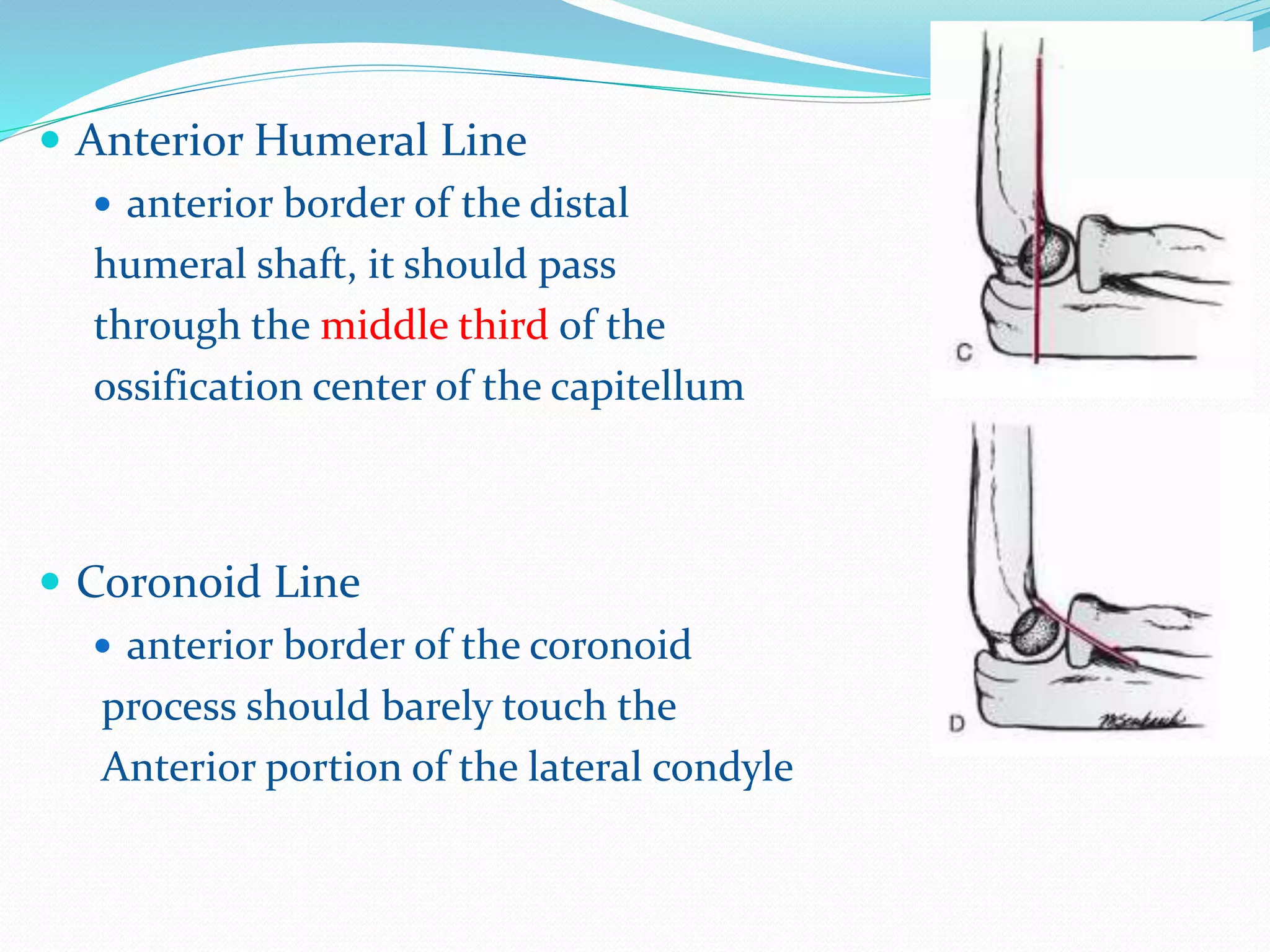 Supra condylar humerus fracture in children | PPTX