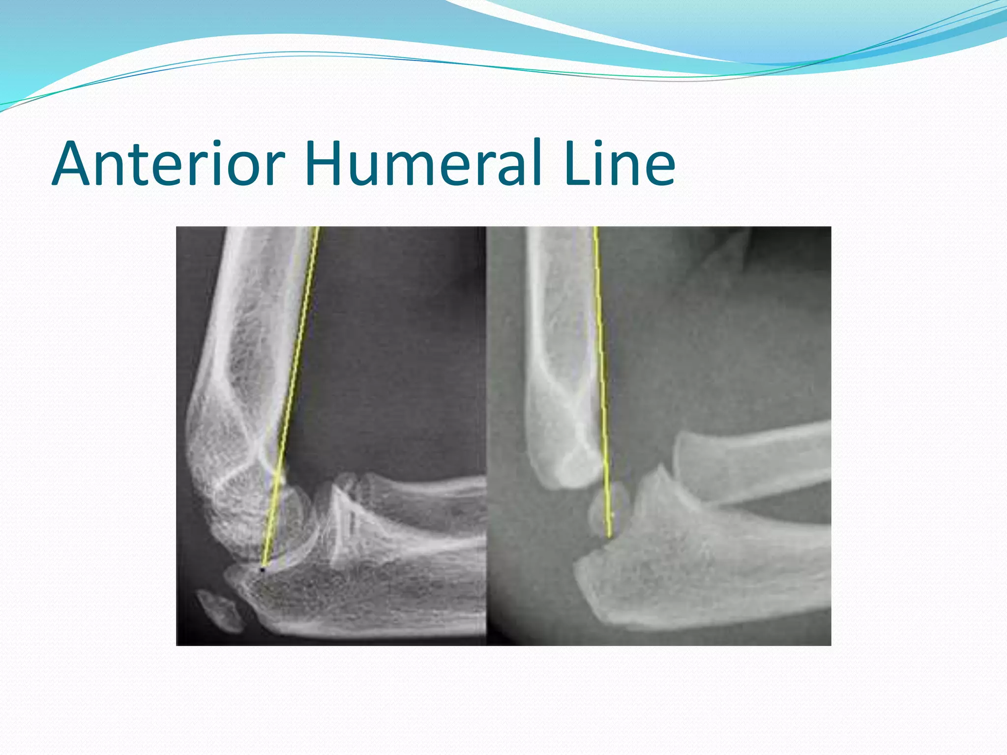 Supra condylar humerus fracture in children | PPTX