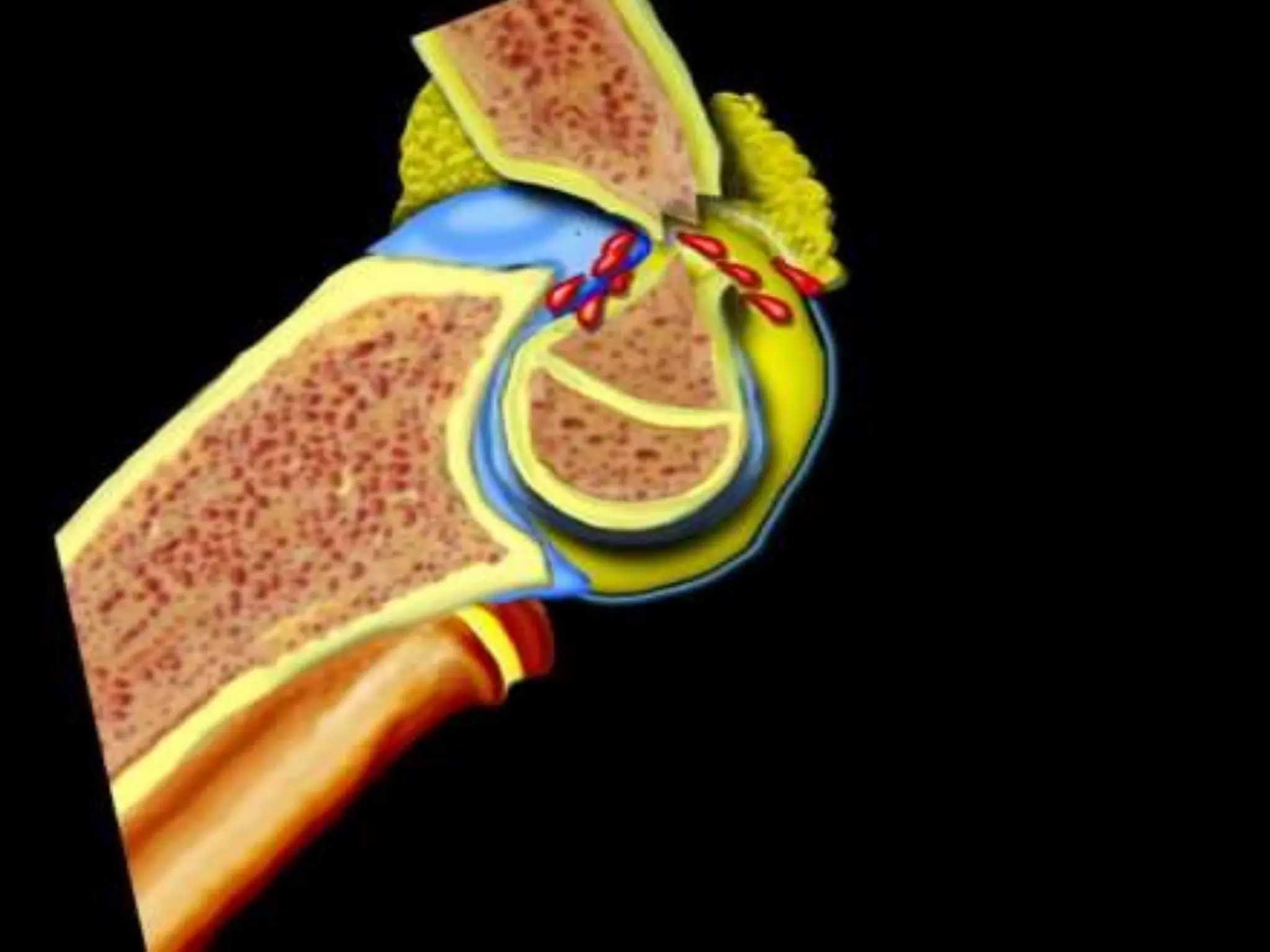 Supra condylar humerus fracture in children | PPTX