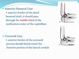 Supra condylar humerus fracture in children | PPTX
