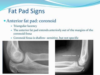 Supra condylar humerus fracture in children | PPTX