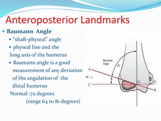 Supra condylar humerus fracture in children | PPT