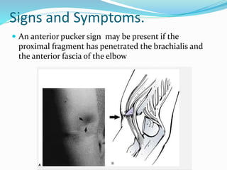 Supra condylar humerus fracture in children | PPT