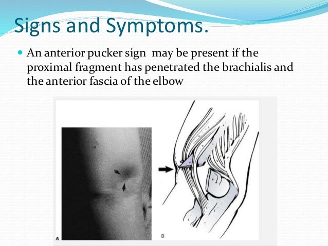 Supra condylar humerus fracture in children