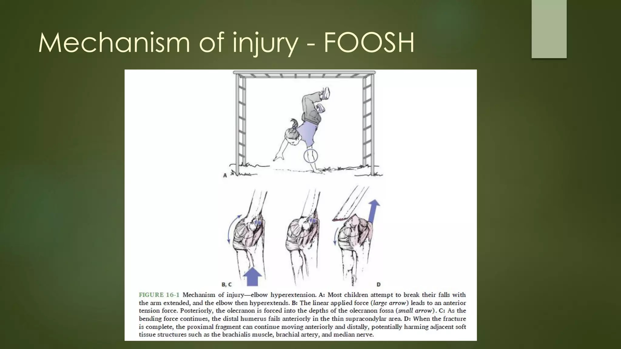 Supracondylar humerus fractures in children | PDF