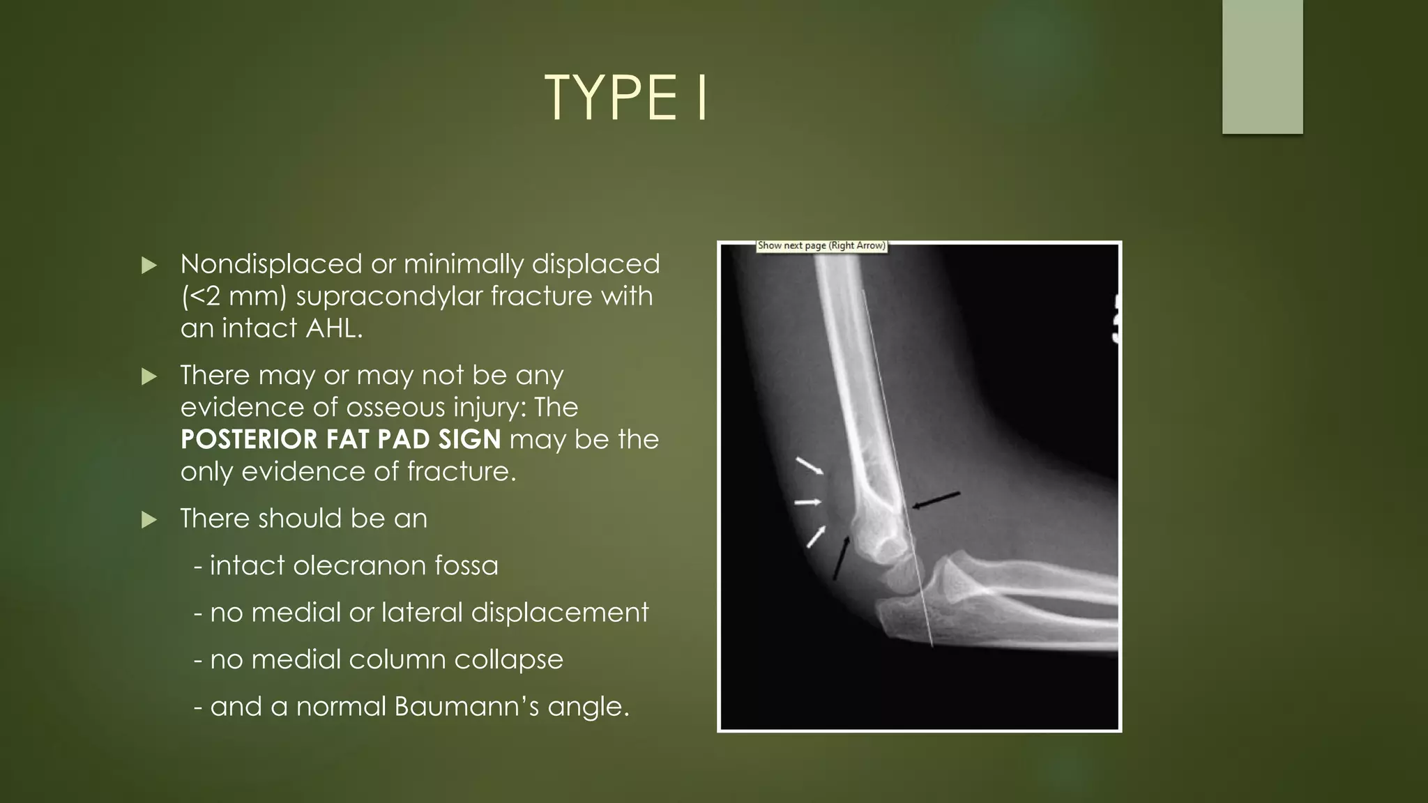 Supracondylar humerus fractures in children | PDF