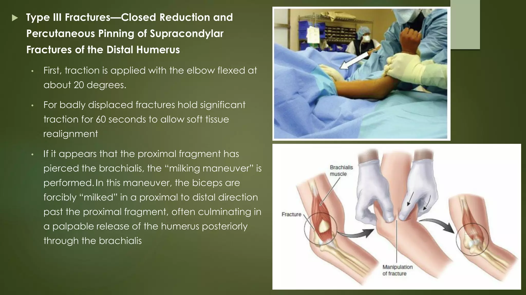 Supracondylar humerus fractures in children | PDF