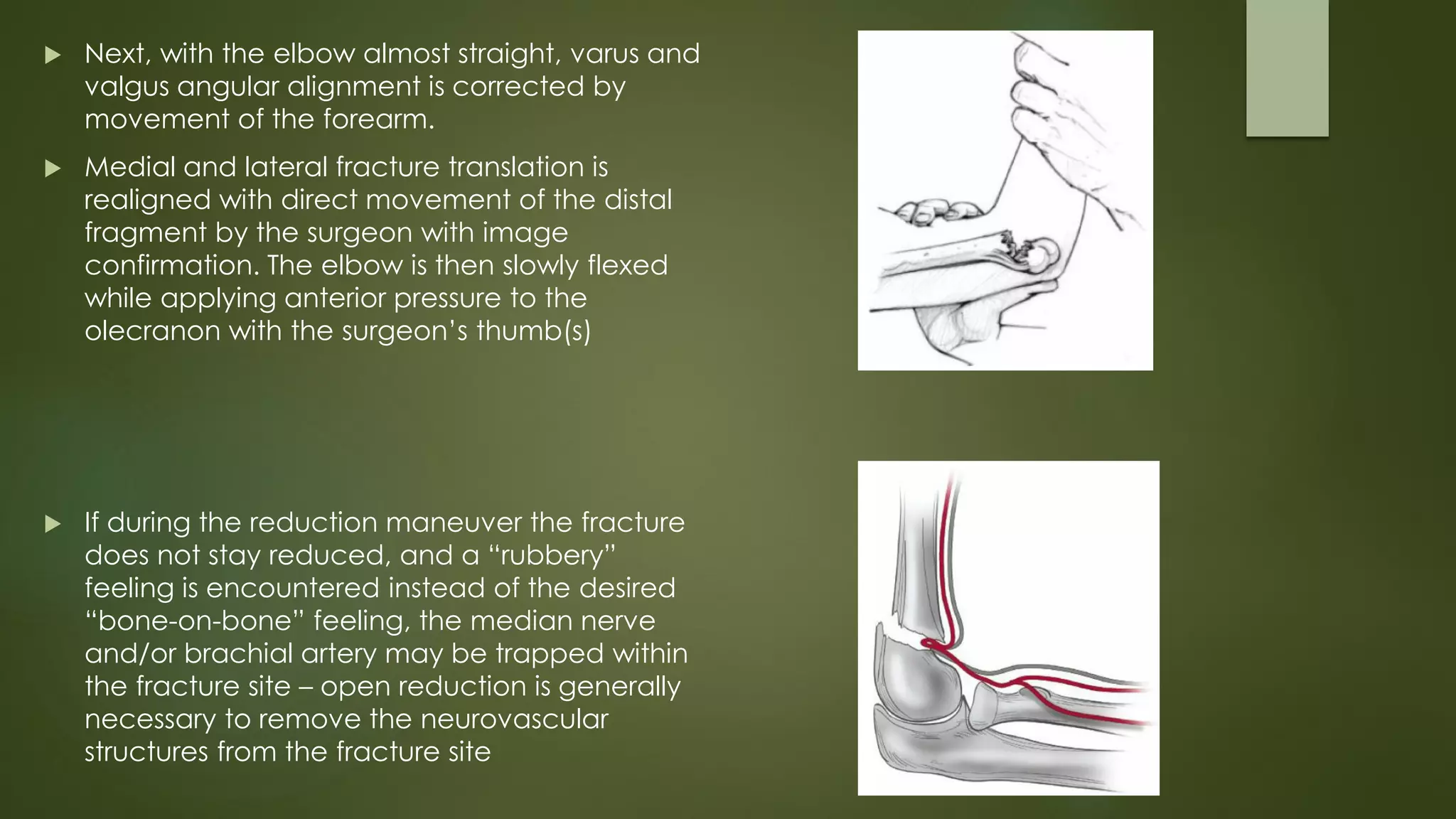 Supracondylar humerus fractures in children | PDF