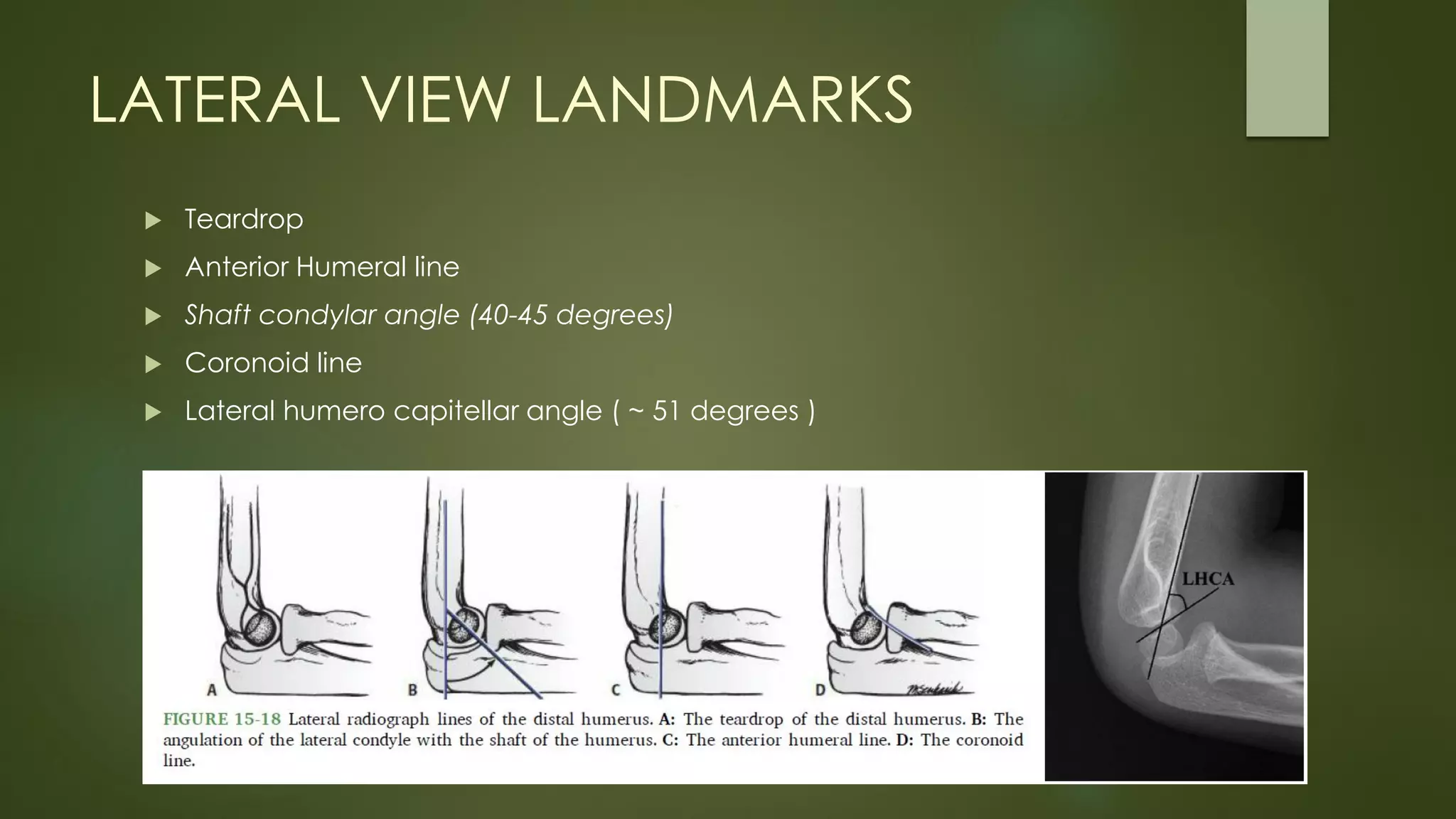 Supracondylar humerus fractures in children | PDF