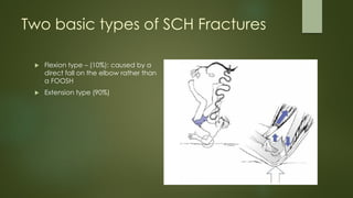 Supracondylar humerus fractures in children | PDF