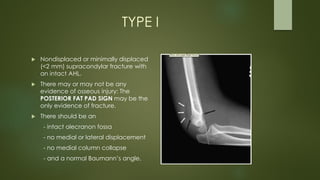 Supracondylar humerus fractures in children | PDF