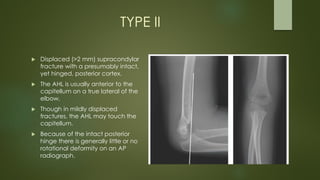Supracondylar humerus fractures in children | PDF
