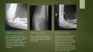 Supracondylar humerus fractures in children | PDF