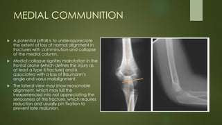 Supracondylar humerus fractures in children | PDF