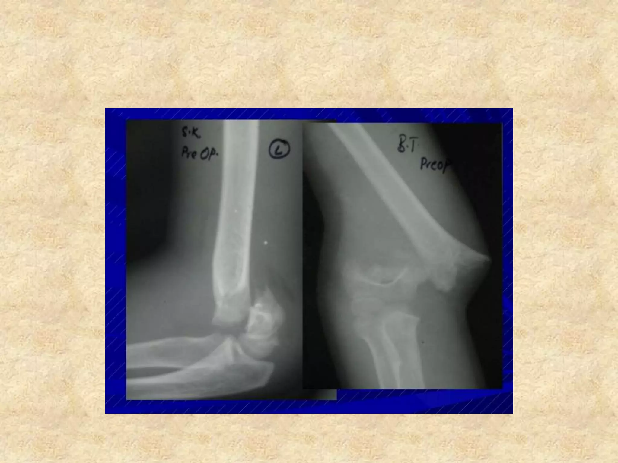 Supracondylar humerus fractures in children | PPTX