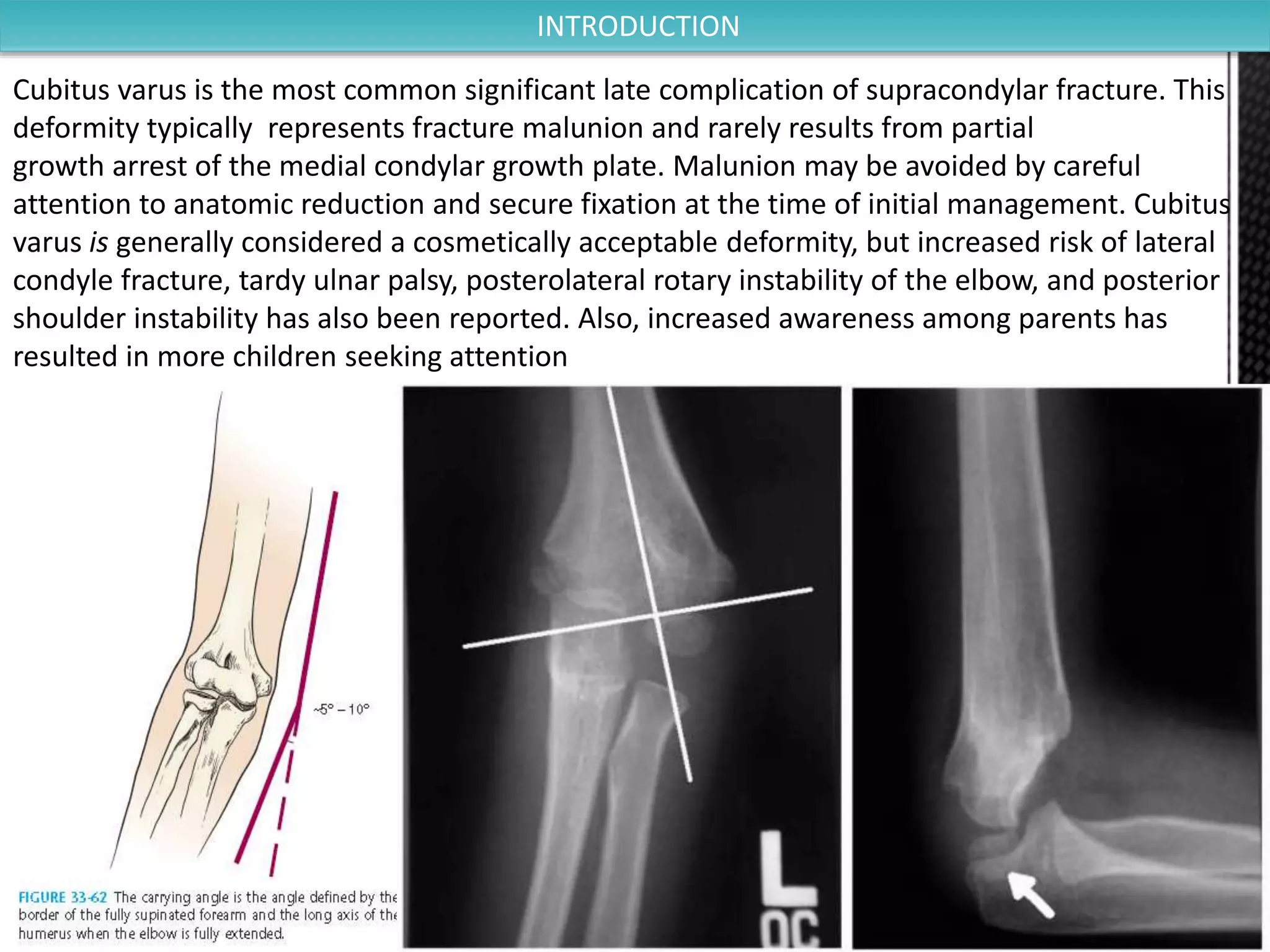 Supracondylar osteotomy for treatment of cubitus varus | PPTX