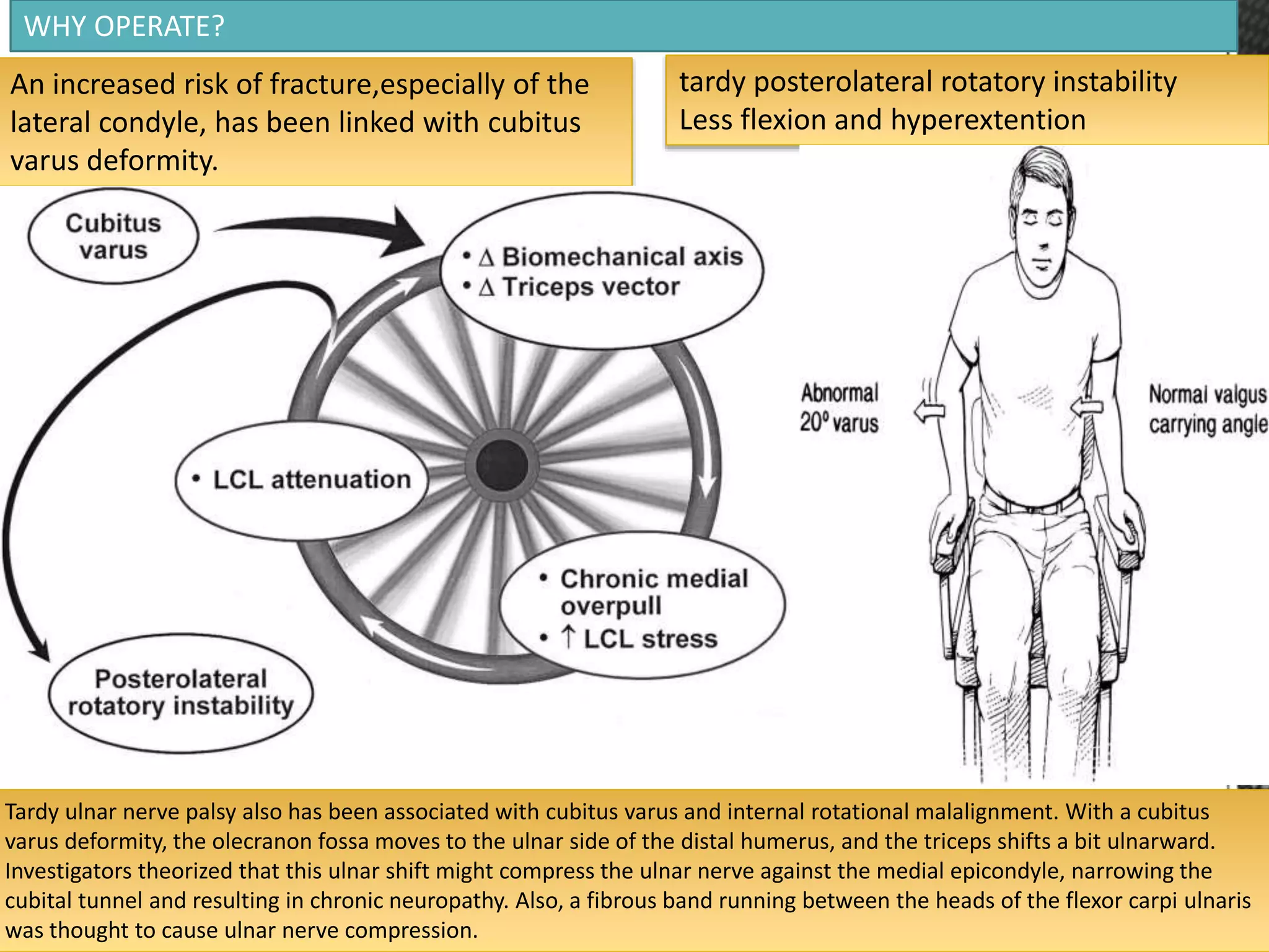 Supracondylar osteotomy for treatment of cubitus varus | PPTX