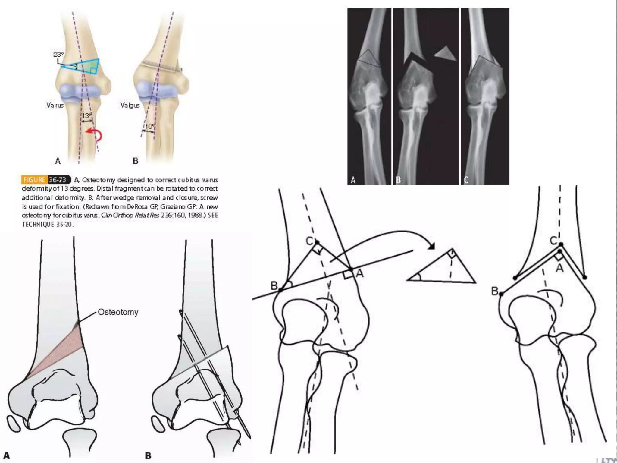 Supracondylar osteotomy for treatment of cubitus varus | PPT