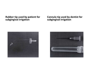 Supragingival and Subgingival Irrigation.pptx