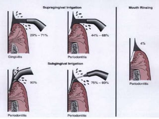 Supragingival and Subgingival Irrigation.pptx