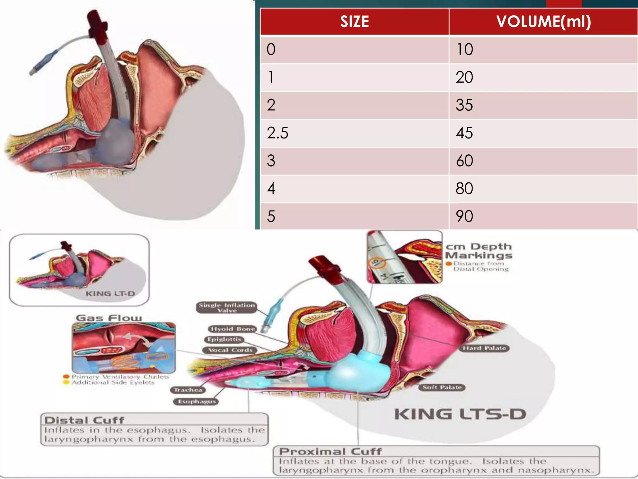 Supraglottic airway device | PPTX