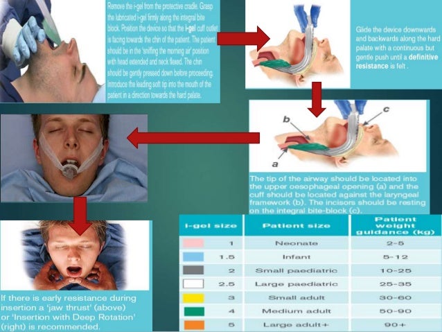 Supraglottic airway device