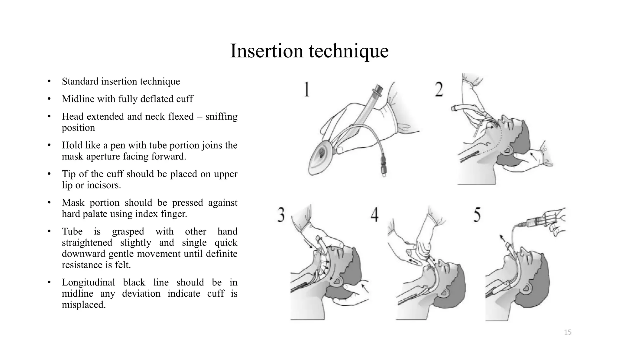 Supraglottic Airway Devices -.pptx