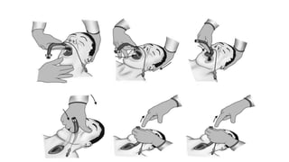 Supraglottic airway devices | PPTX