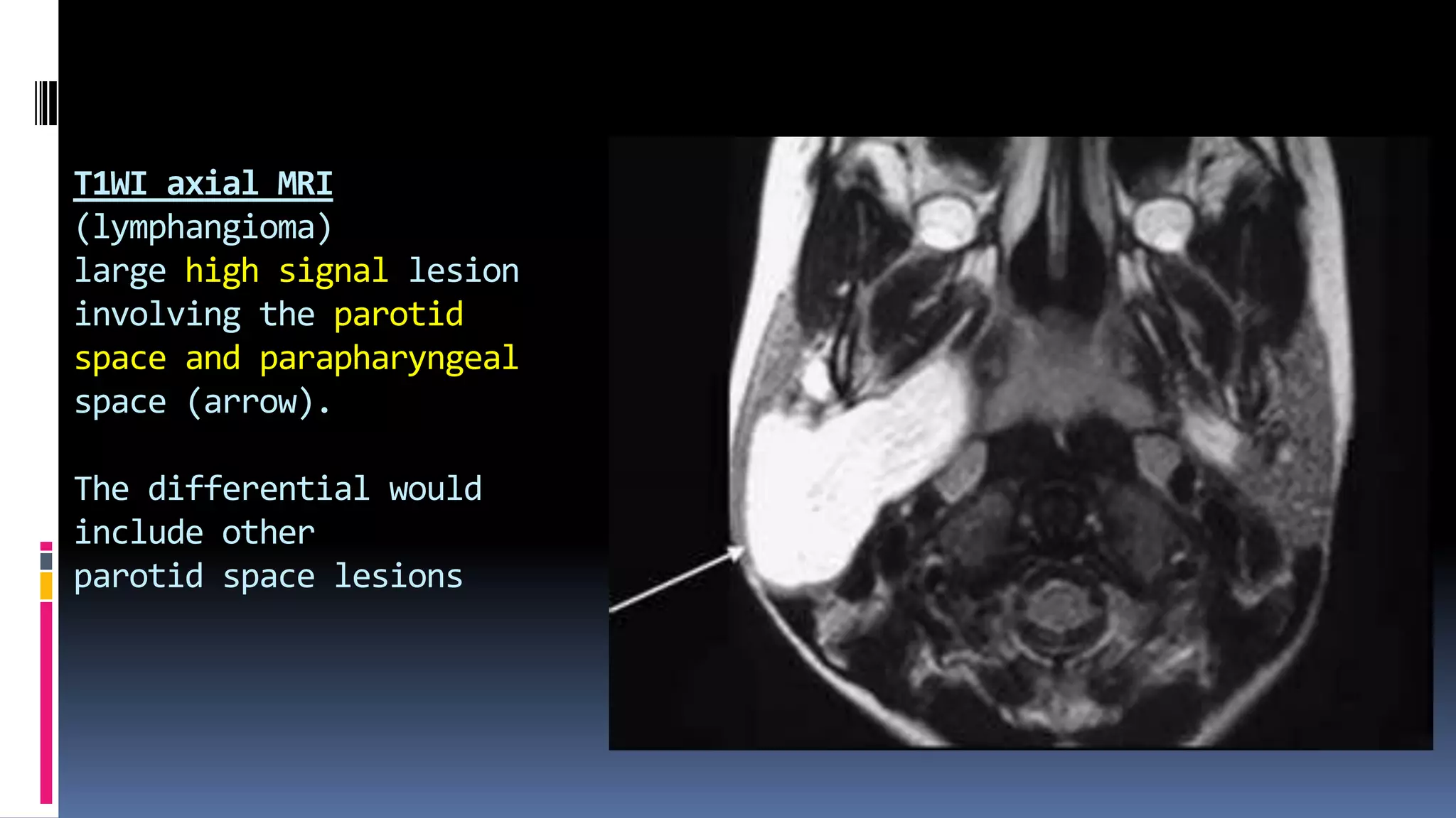 Suprahyoid cysts on CT & MRI | PPTX