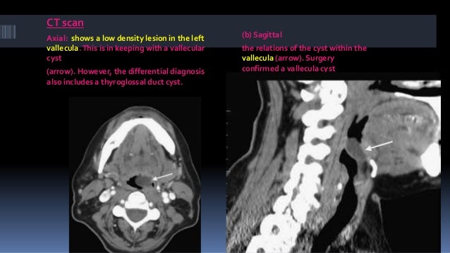 Vallecular Cyst Ct