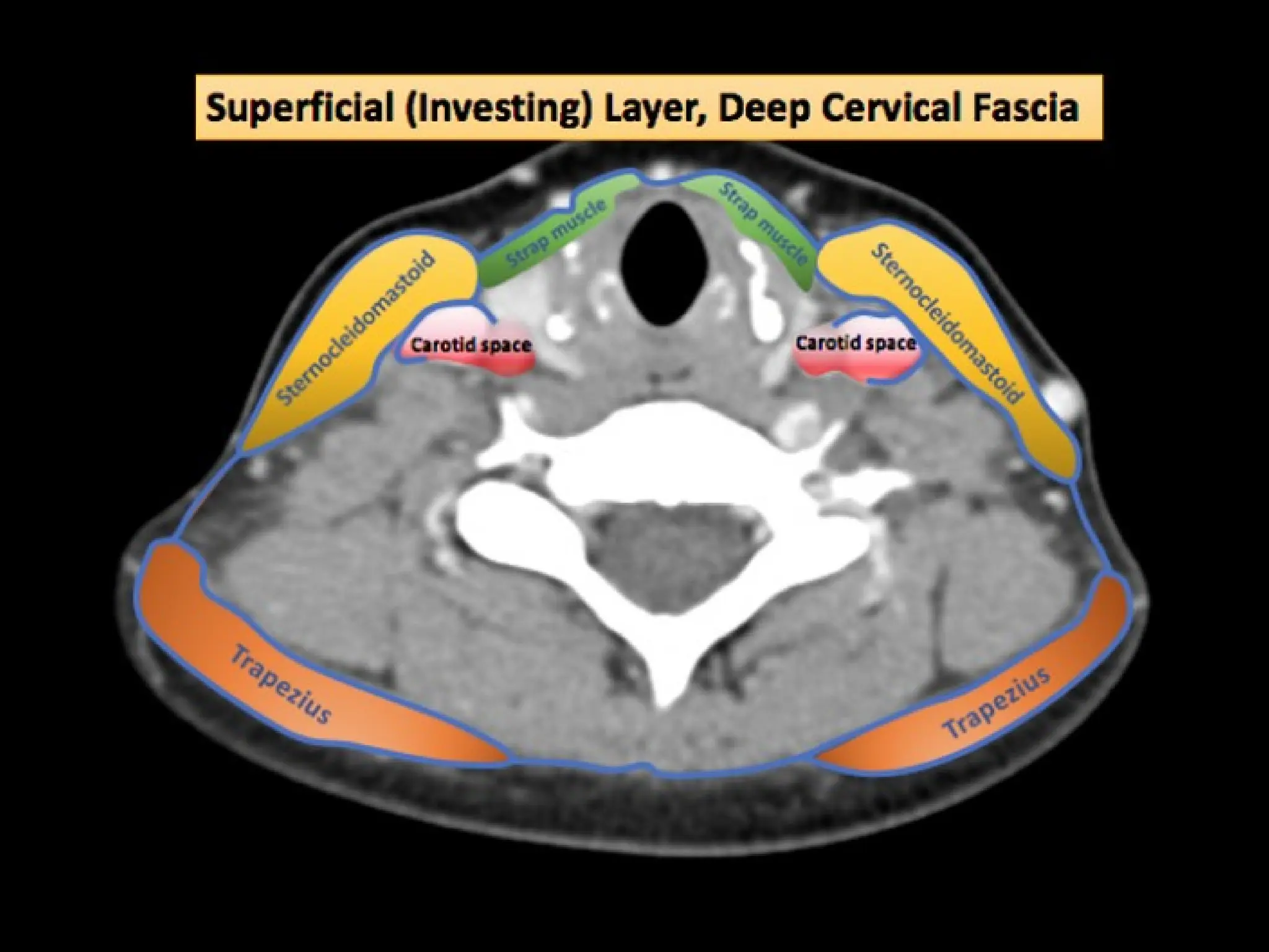 Cross sectional imaging of Suprahyoid Neck Spaces.pptx