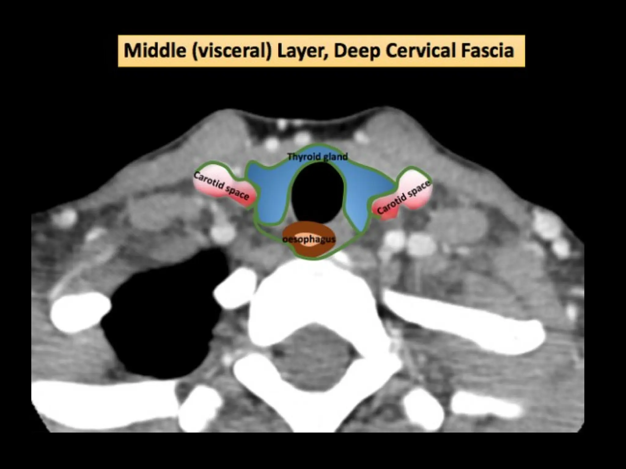 Cross sectional imaging of Suprahyoid Neck Spaces.pptx