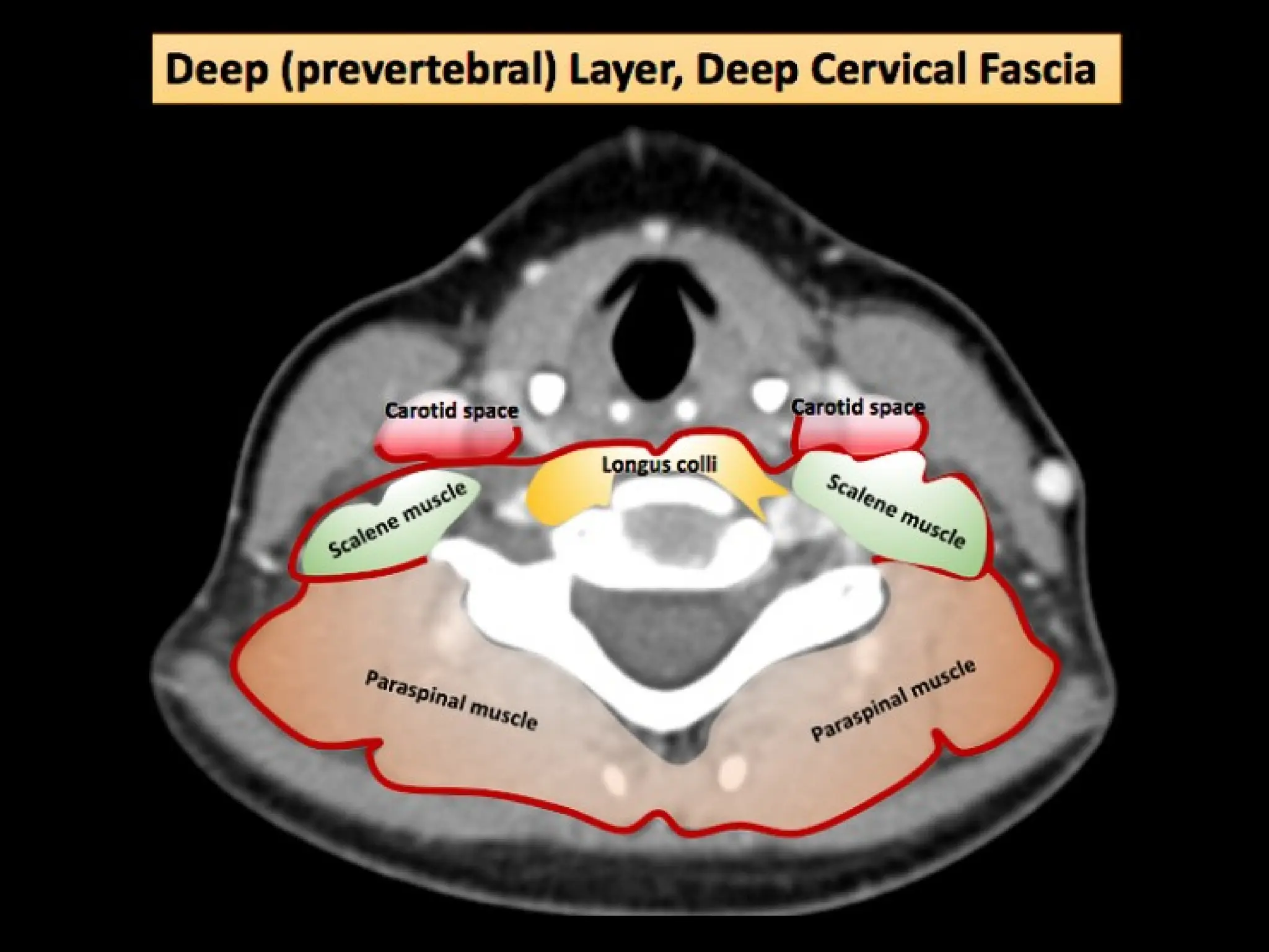Cross sectional imaging of Suprahyoid Neck Spaces.pptx