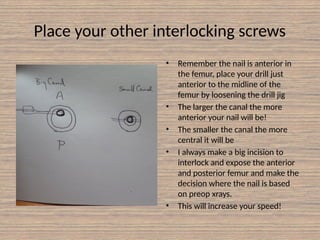 supraintercond femur ORIF, managment .pptx