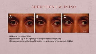Supranuclear control of eye movements | PPTX