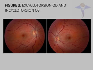 Supranuclearcontrolofgaze 180318184028 | PDF
