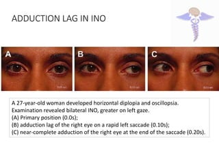 Supranuclear control of gaze | PPTX