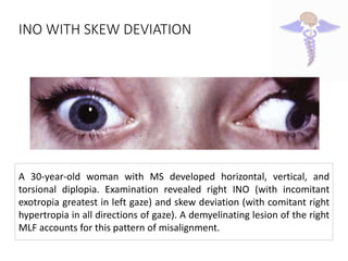 Supranuclear control of gaze | PPTX