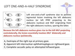 Supranuclear control of gaze | PPTX