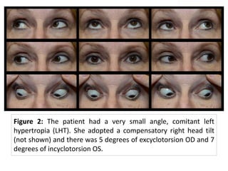 Supranuclear control of gaze | PPTX