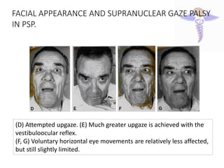 Supranuclear control of gaze | PPTX