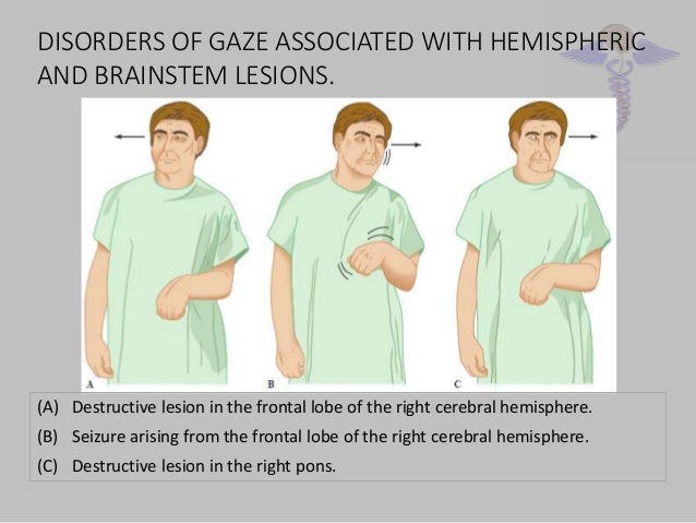 Supranuclear control of gaze