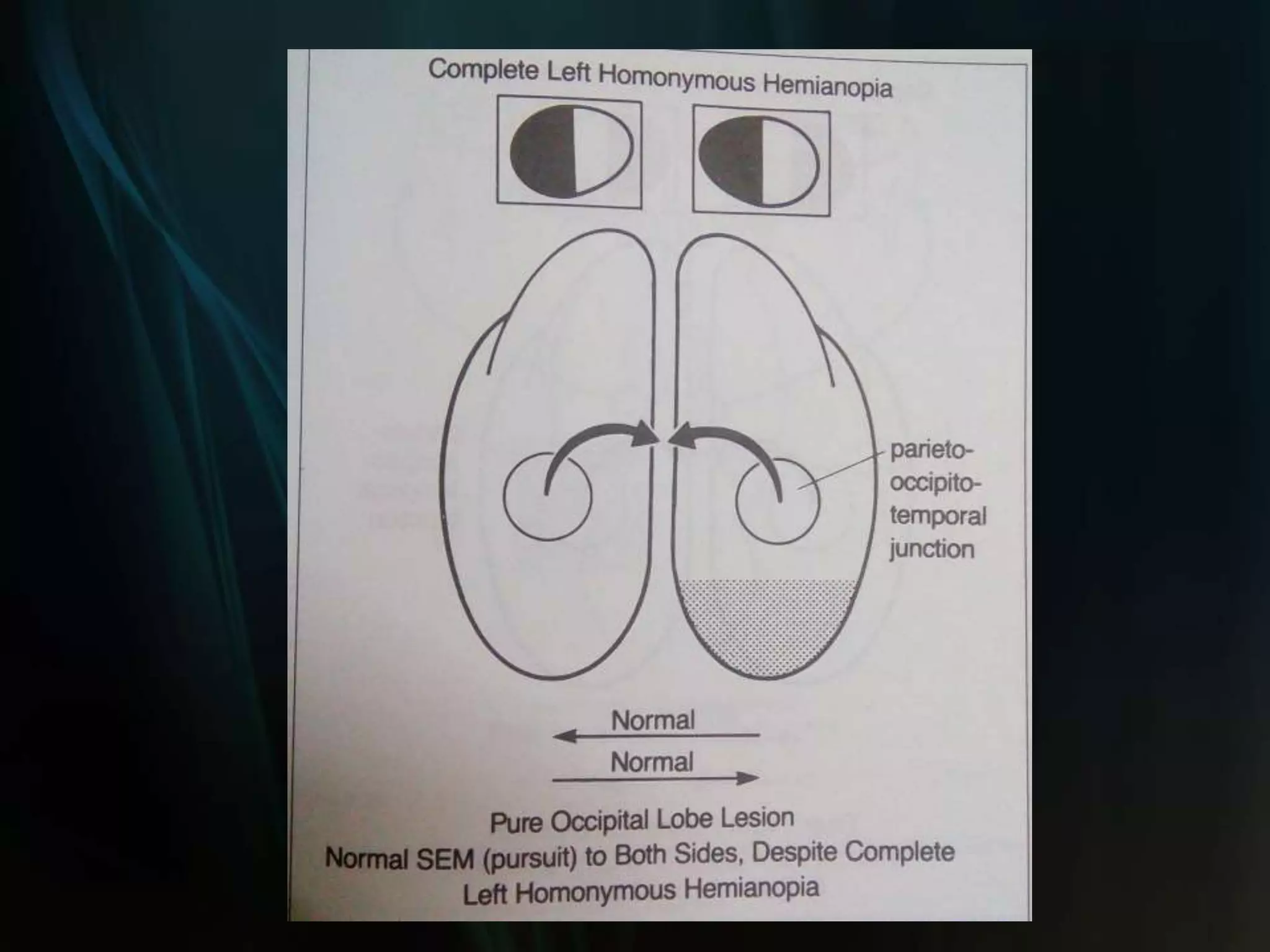 Supranuclear disorders of ocular motility | PPTX
