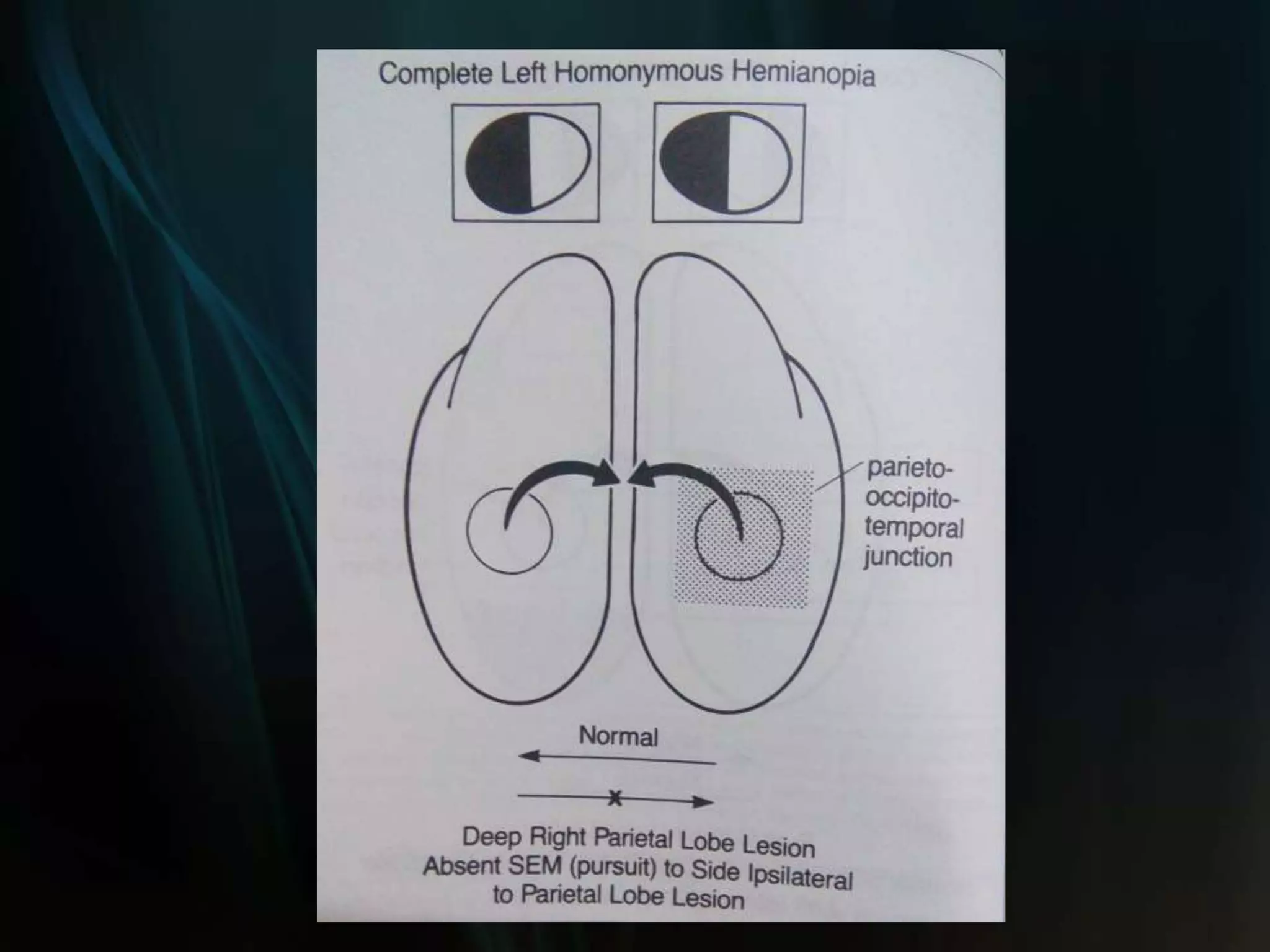 Supranuclear disorders of ocular motility | PPTX