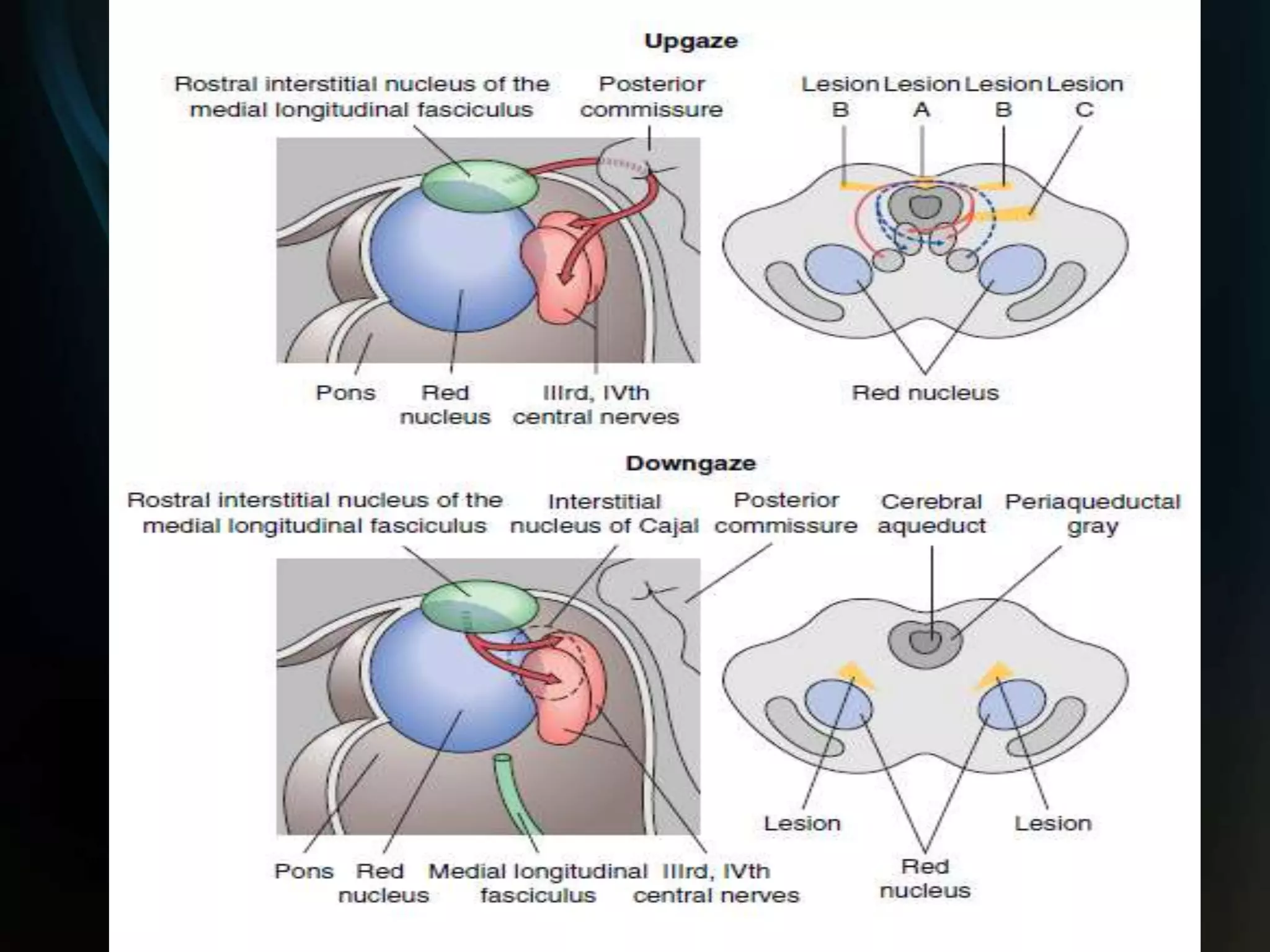 Supranuclear disorders of ocular motility | PPTX