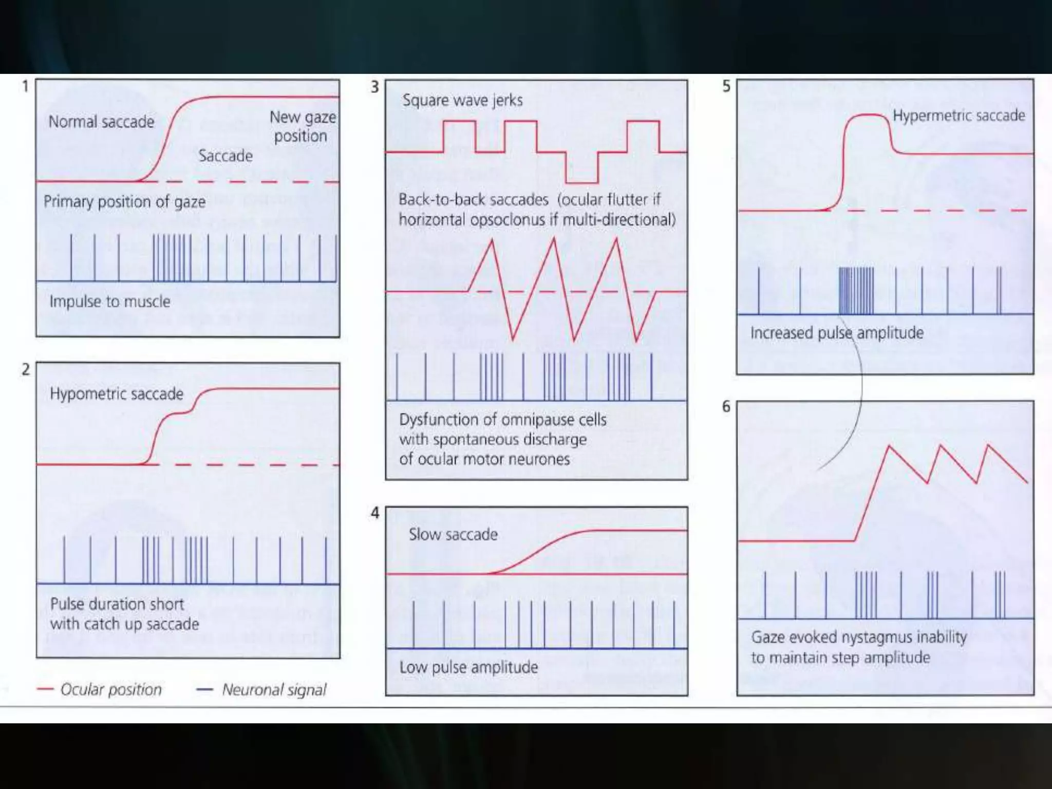 Supranuclear disorders of ocular motility | PPTX