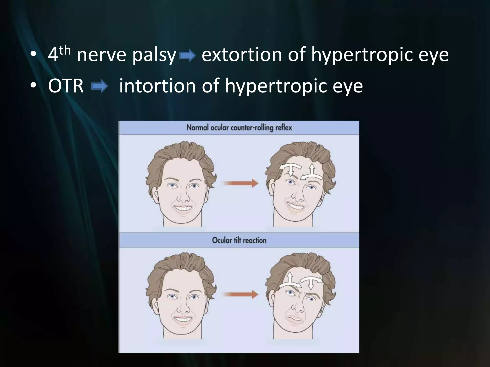 Supranuclear disorders of ocular motility | PPTX