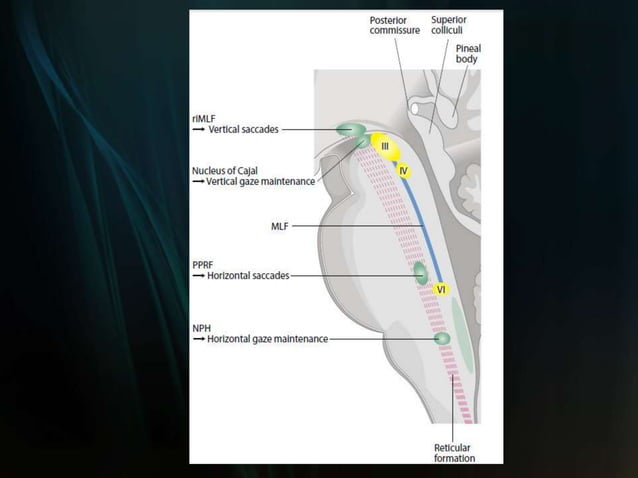 Supranuclear disorders of ocular motility | PPTX