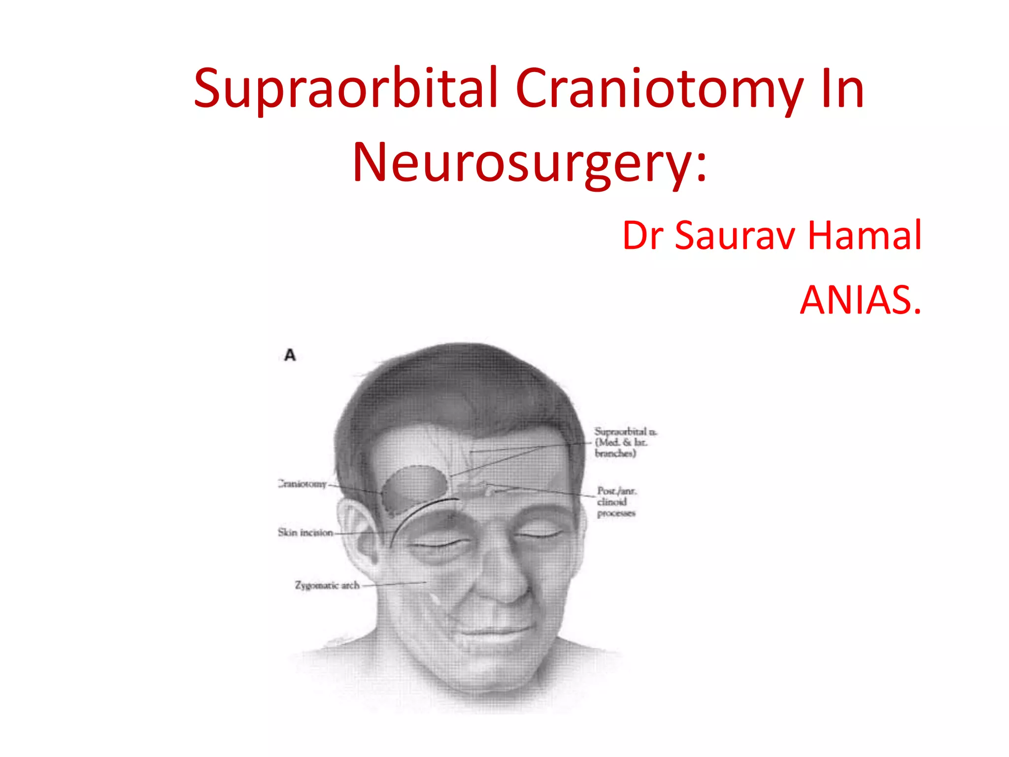 Supraorbital craniotomy. | PPTX