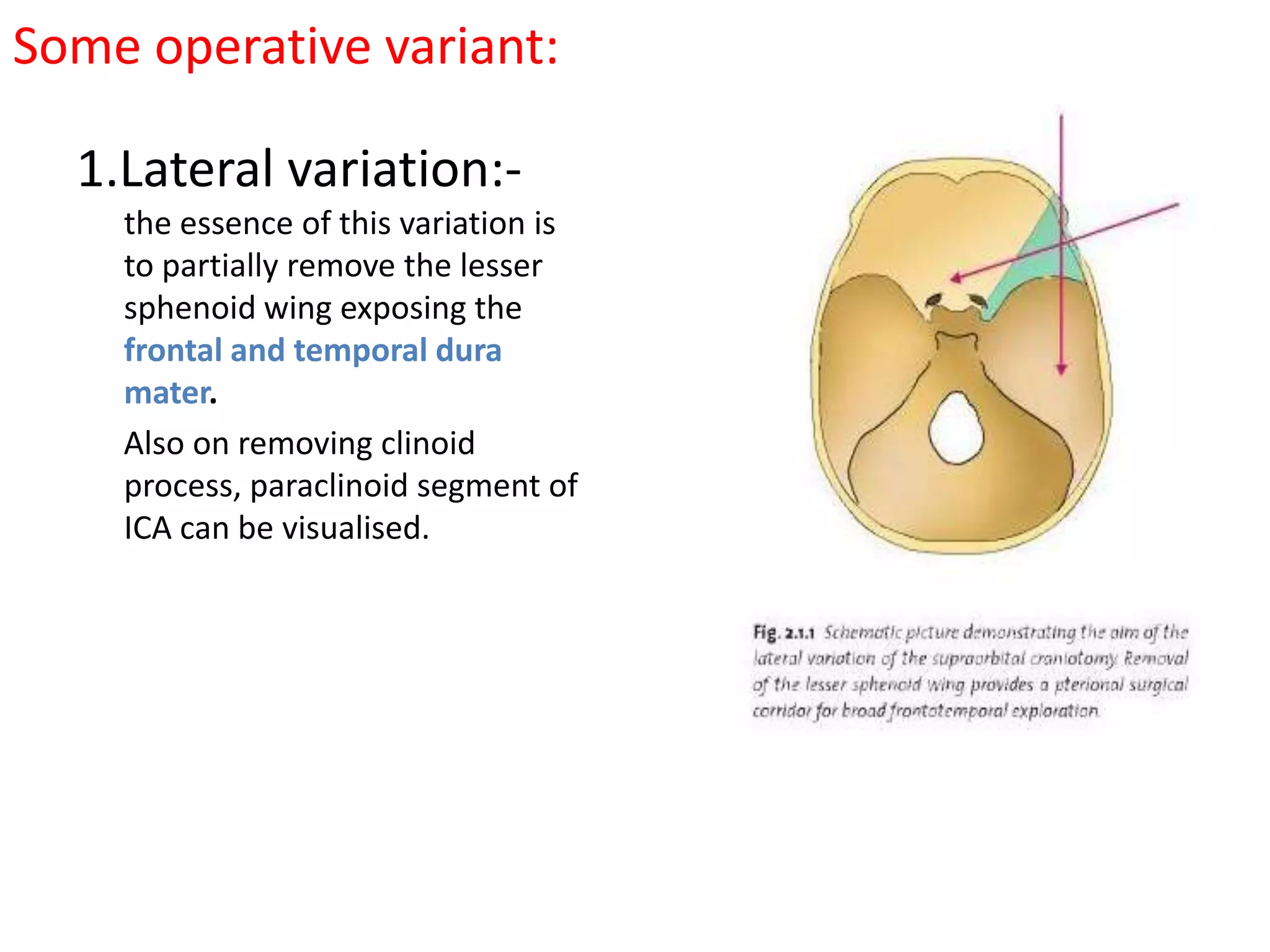 Supraorbital craniotomy. | PPTX
